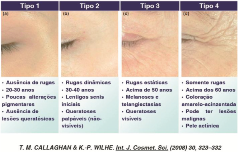 A classificação de GLOGAU - Os 4 Níveis de Envelhecimento - Contox