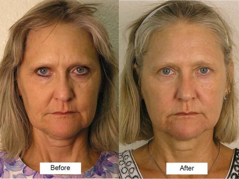 Microcorrentes na Estética para rejuvenescimento do rosto