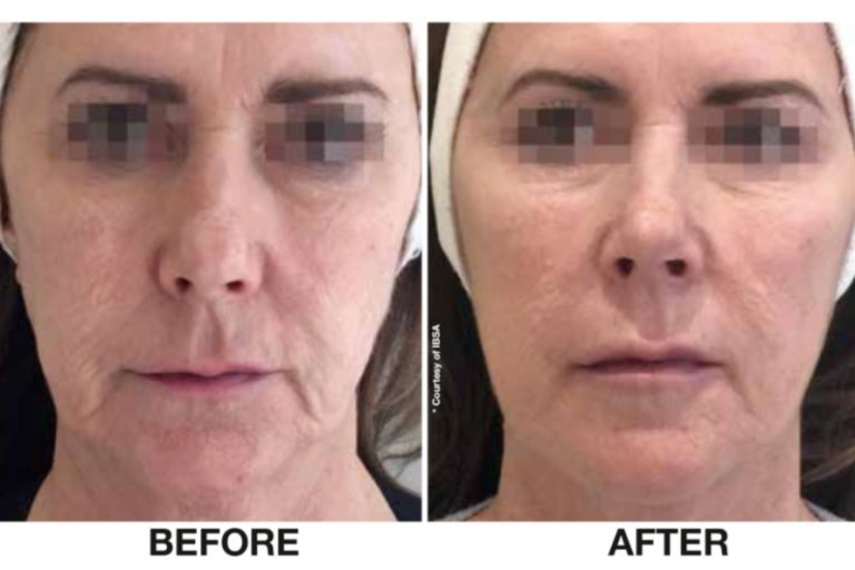 Profhilo: O guia definitivo da grande tendência de Skincare - Contox